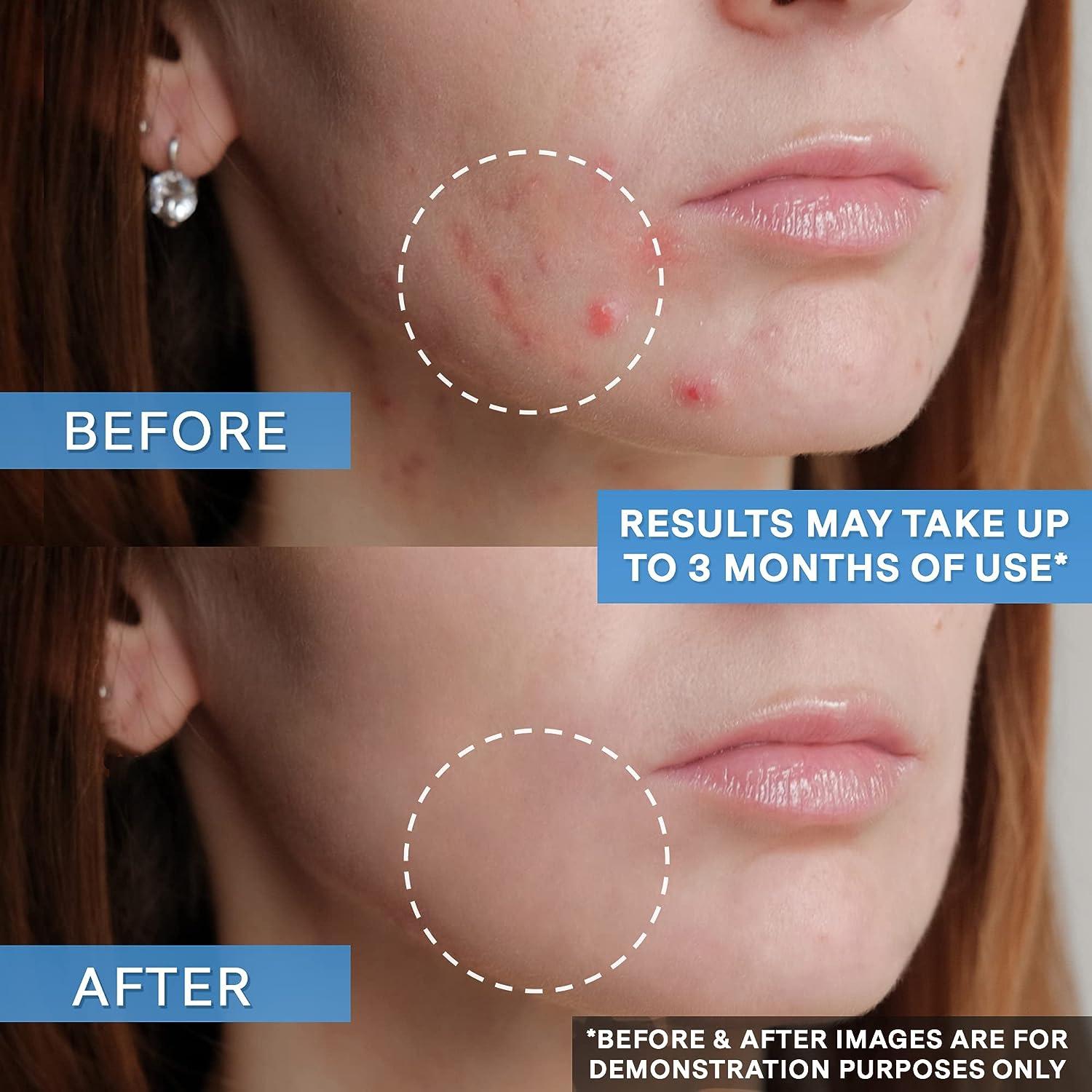 Curist Adapalene 0.1% Acne Gel - Topical Retinoid Acne Treatment for ...