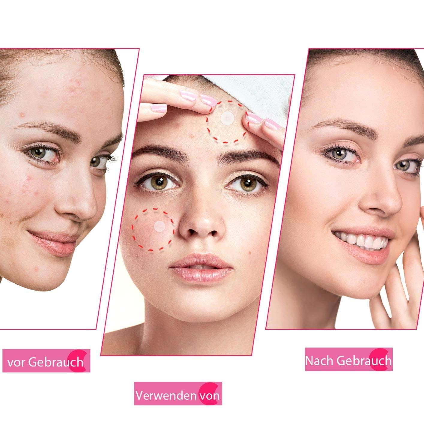 JOLVKA Acne Pimple Patch - 120 Hydrocolloid Plasters for Acne & Pimples ...