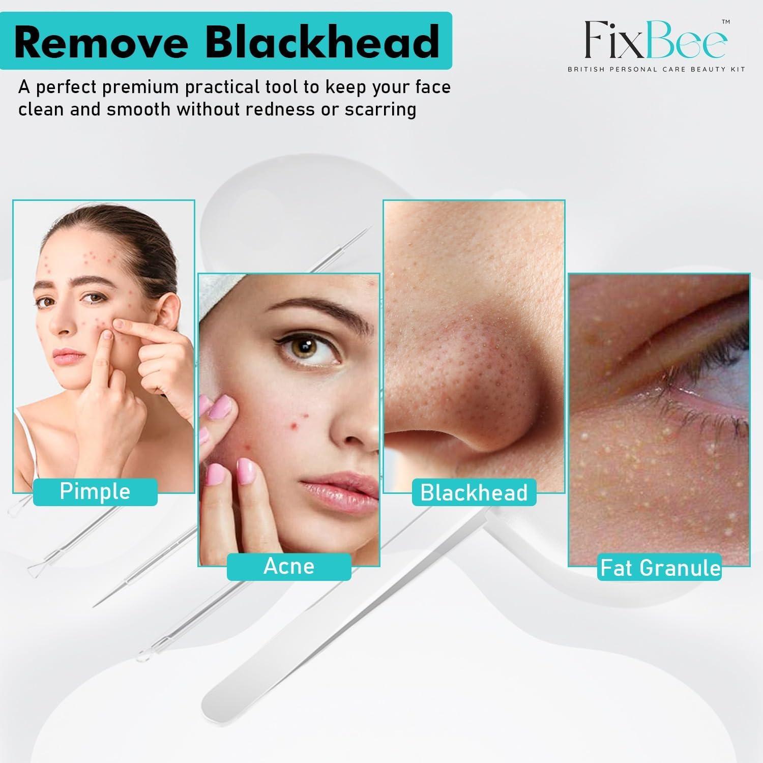 5PC Blackhead & Pimple Removal Kit with Tweezers - Facial Spot Popping ...