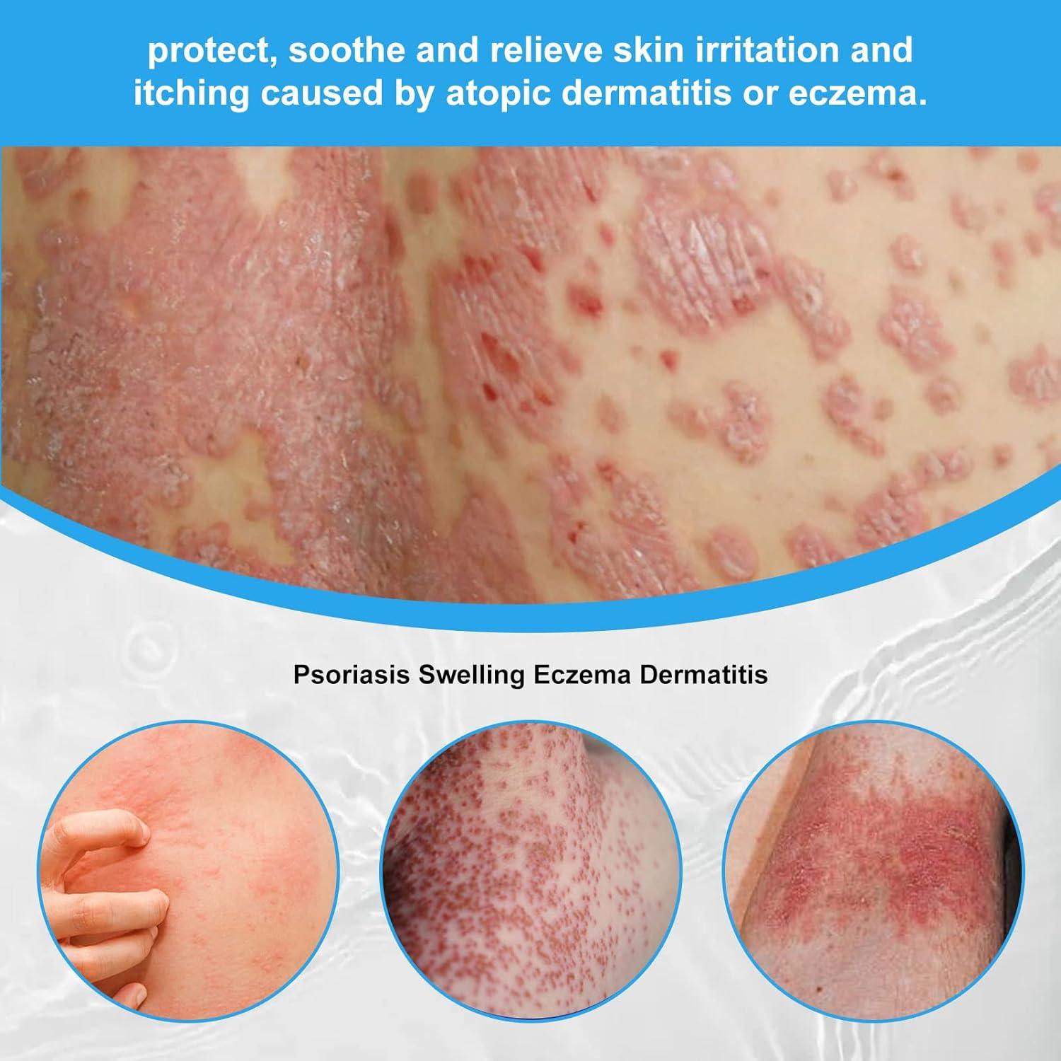 2pcs 30ml Psoriasis Relief Solution Spray for Skin - Itch Relief ...