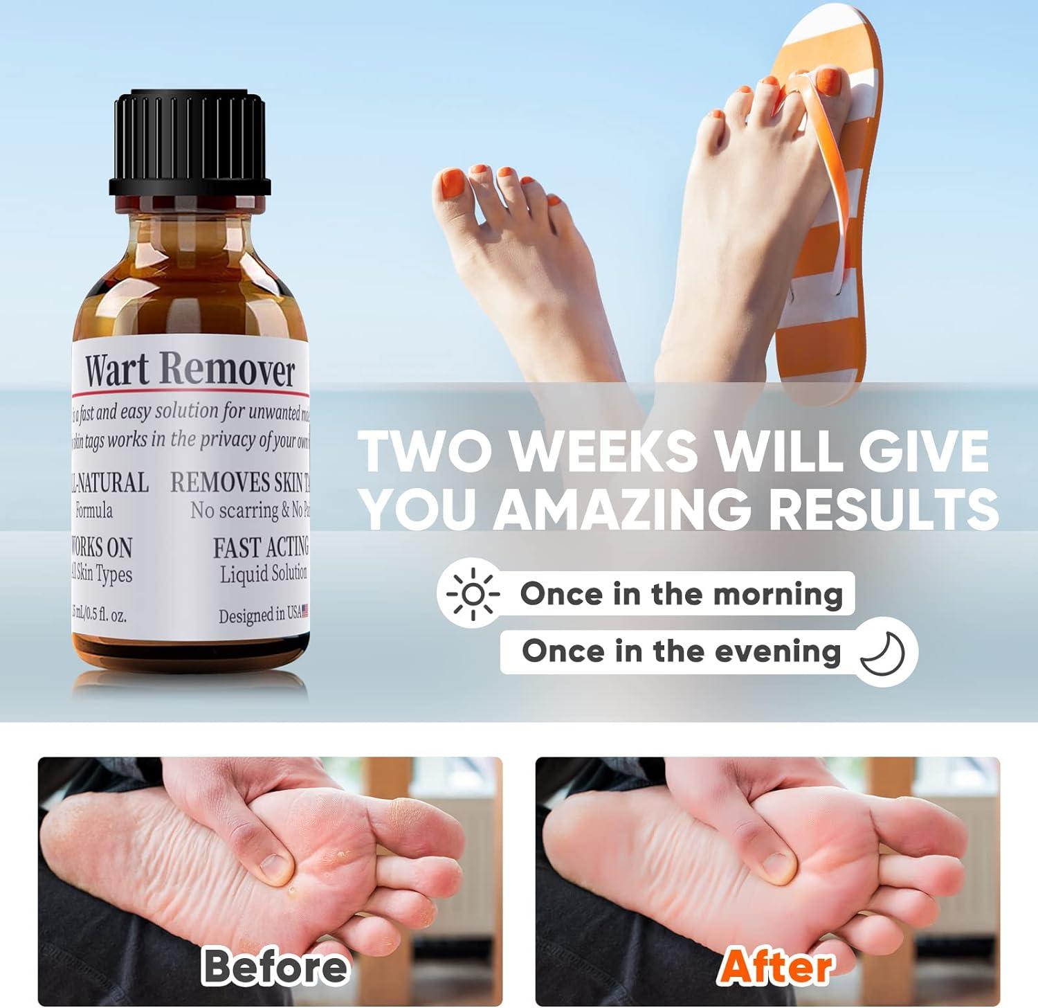 WABRINY Wart Remover Liquid: Fast-Acting Gel for Plantar Wart, Flat ...