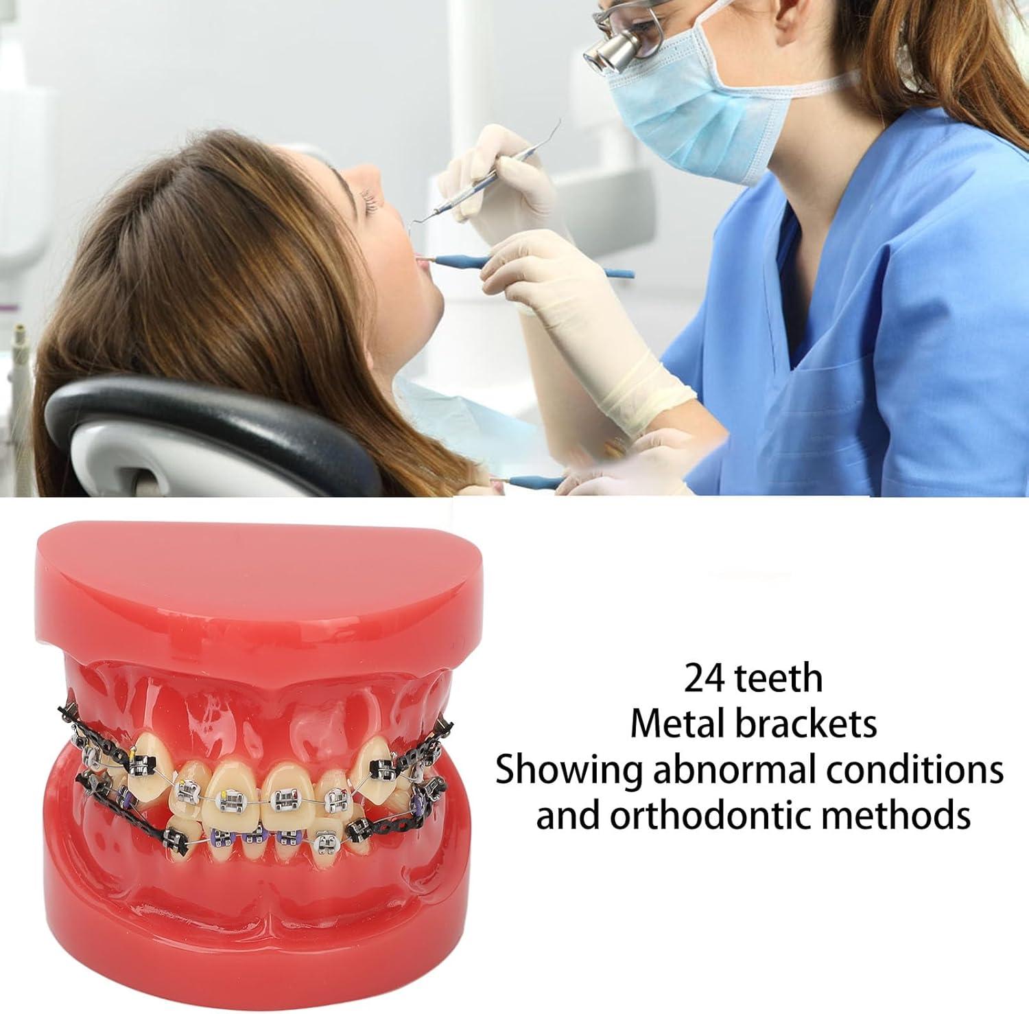 Orthodontic Bracket Model - 24 Teeth Demonstration Model with Metal ...