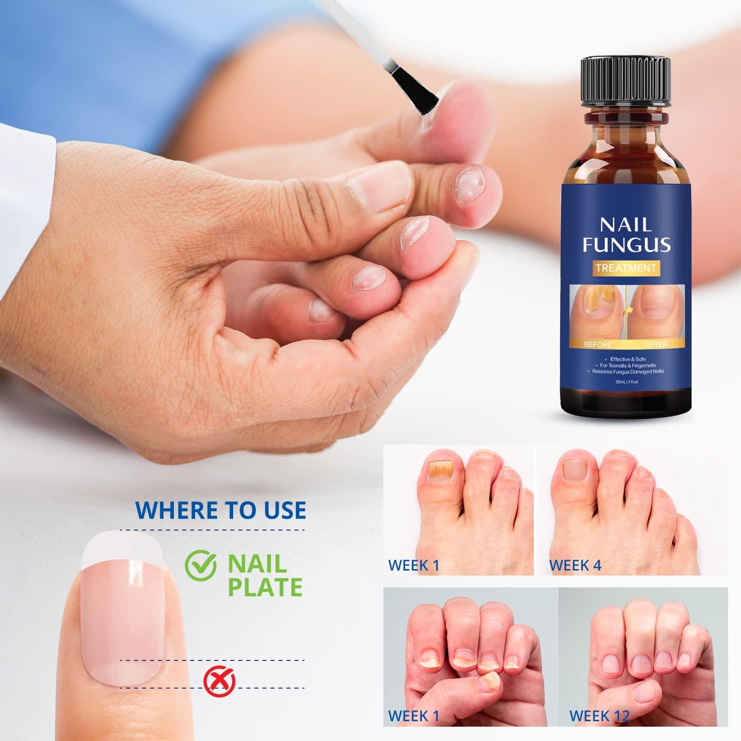 Extra Strength Toe Nail Fungus Treatment - Effective Nail Repair ...
