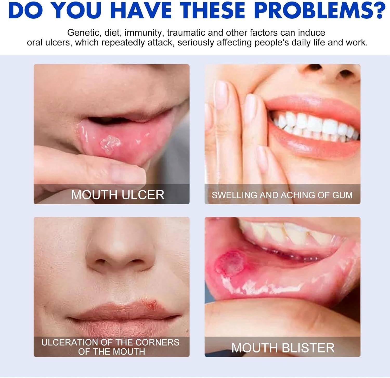 Mouth Ulcer Spray Ulcer Breath Sprays Mouth Ulcer Treatment Spray Ulcer ...