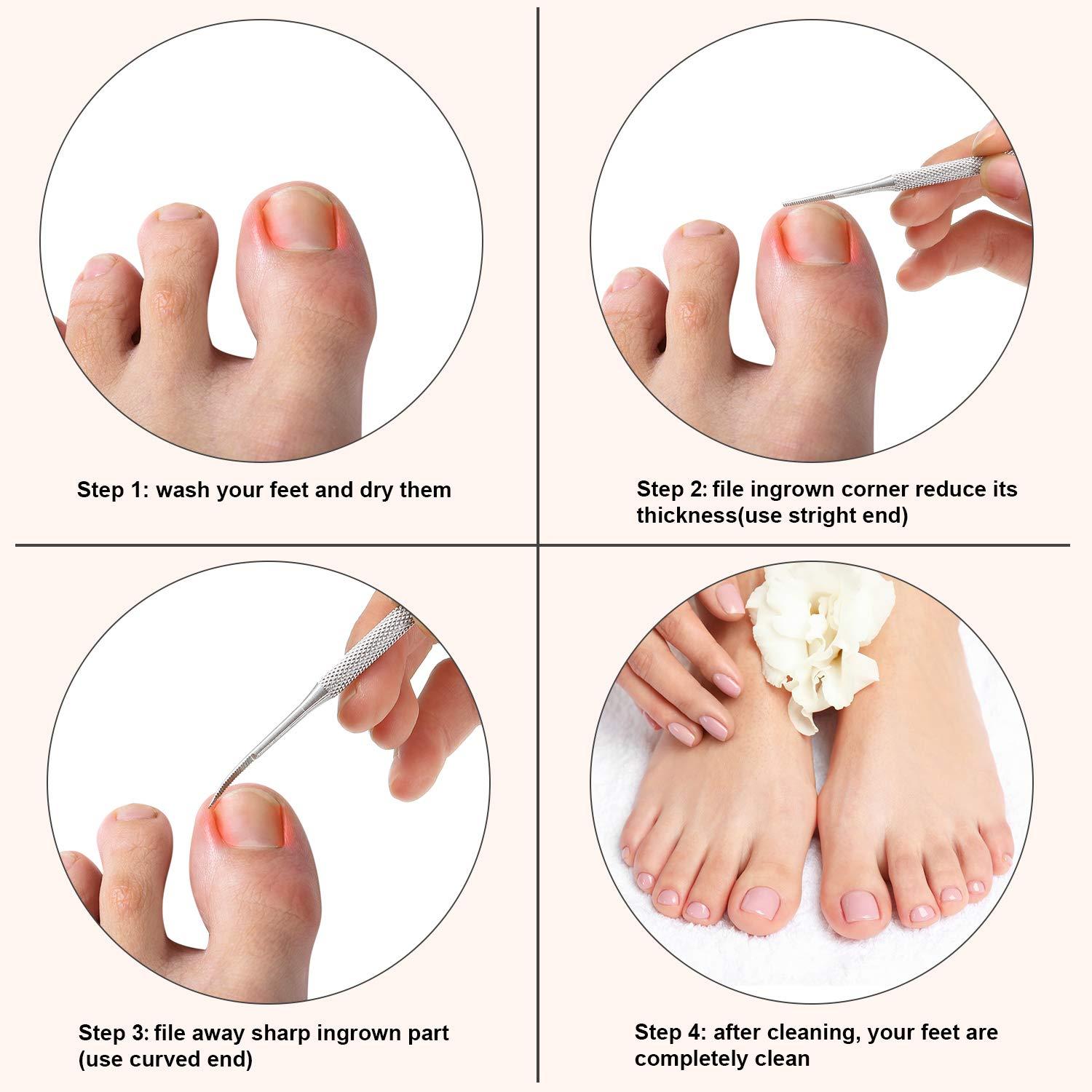 6-Pack Stainless Steel Ingrown Toenail File & Lifter Set | Double-Sided ...