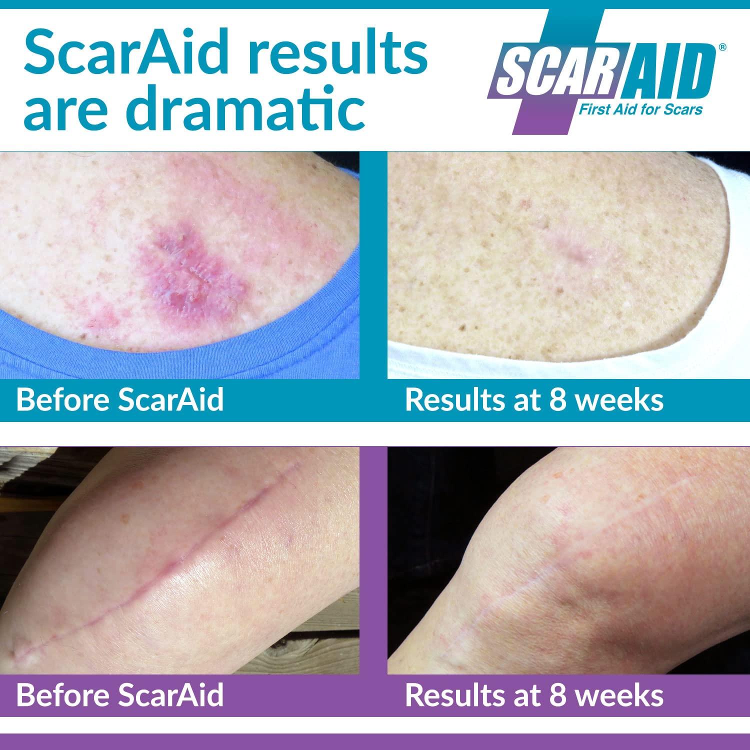 ScarAid Silicone Scar Gel Stick - Effective Scar Management Treatment 4 ...