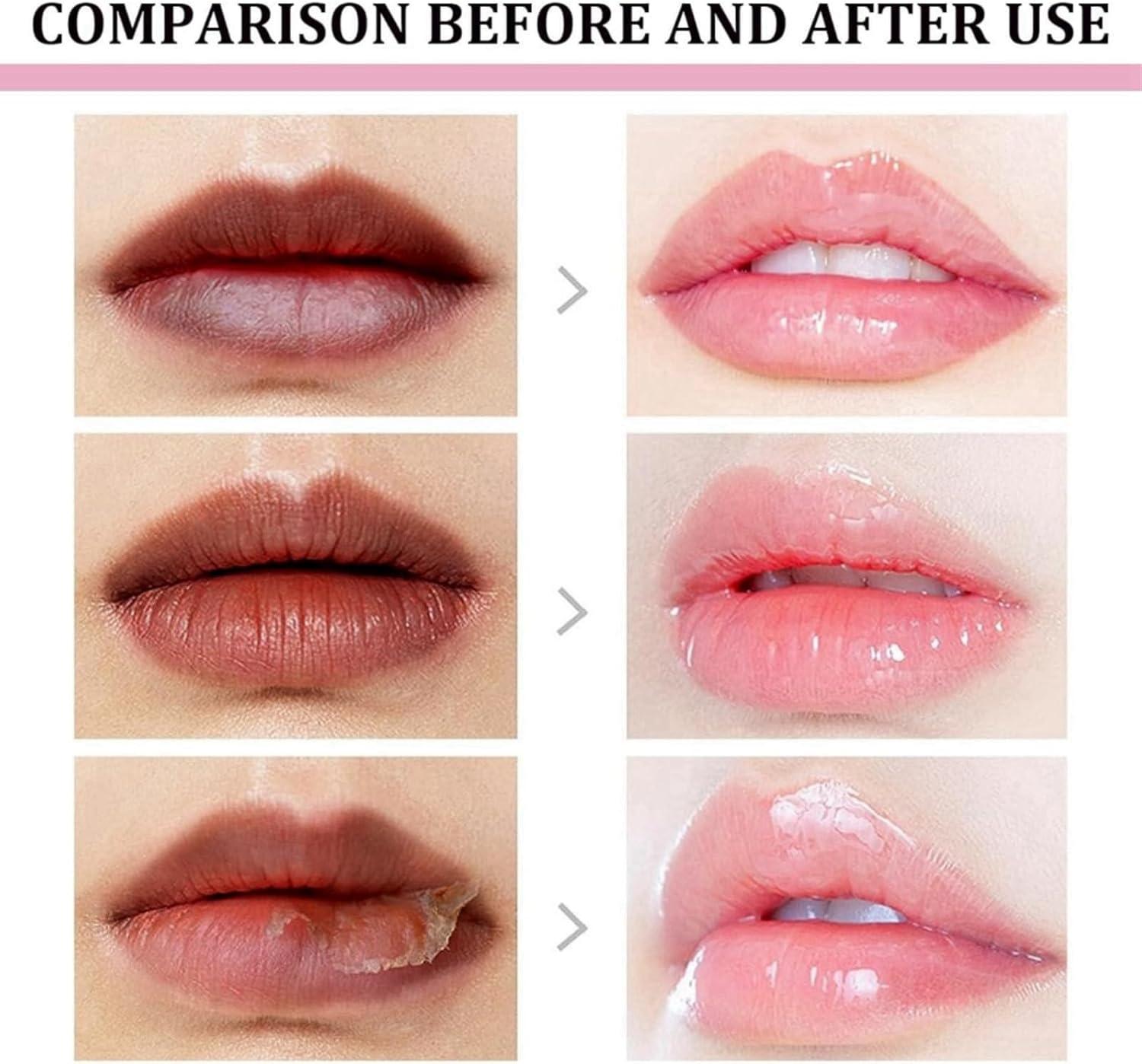 Lip Hyperpigmentation Treatment Lip Lightening For Dark Lips Lip Repair ...