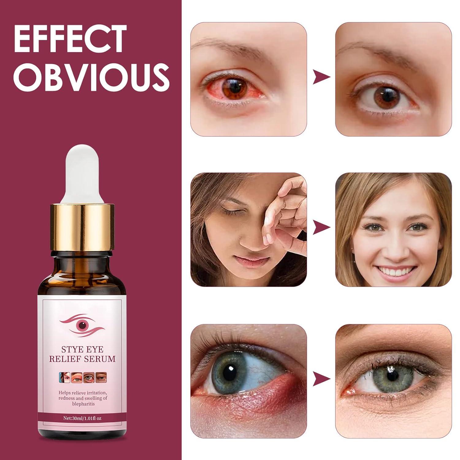 Stye Eye Treatment Chalazion Remover - Fast Relief Serum for Eye ...