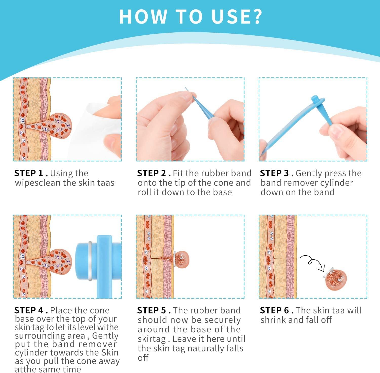 Skin Tag Removal Kit 2-in-1 - Safe for Small to Large (2mm - 8.5mm ...