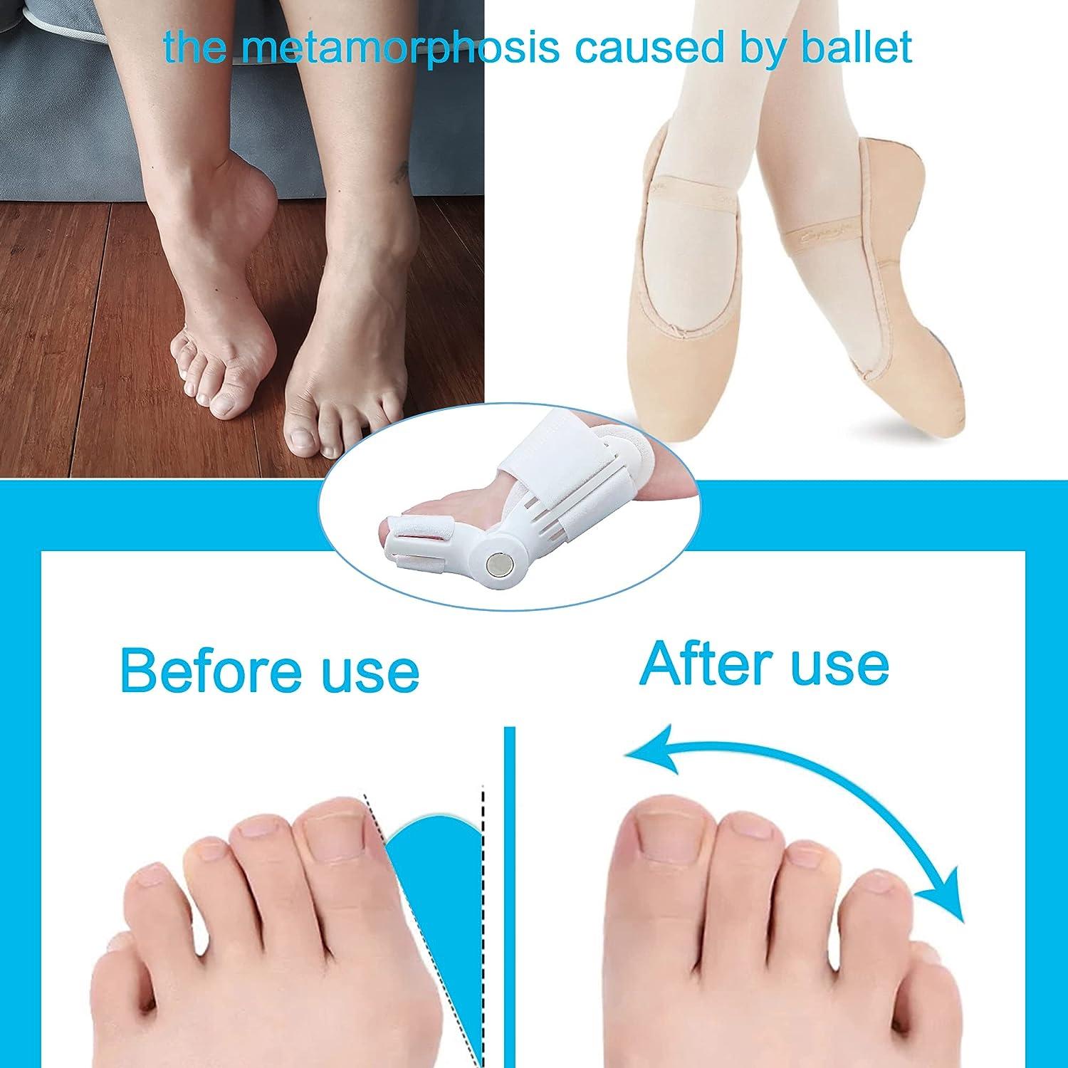 LOEFLIVG Children's Bunion Corrector - Day and Night Set for Toe ...