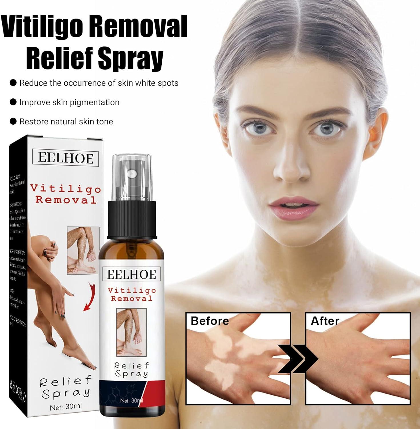VitiligoRemoval Relief Spray Vitiligo Skin Repair Spray Vitiligo Care ...