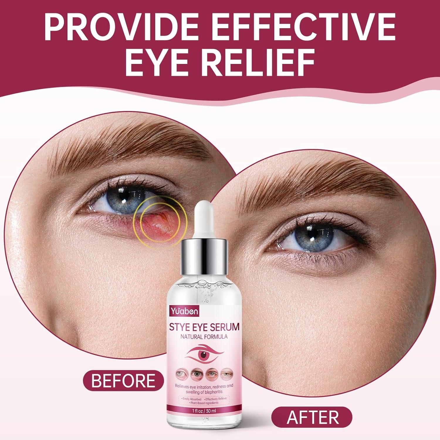 Stye Eye Treatment - Fast Relief Drops for Styes Chalazion ...