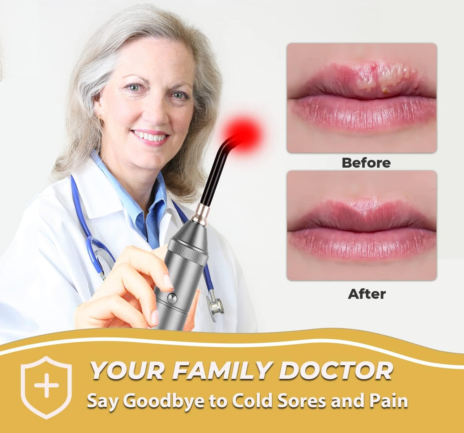 Red Light Therapy Device for Cold Sore Pain Relief - Oral & Facial ...