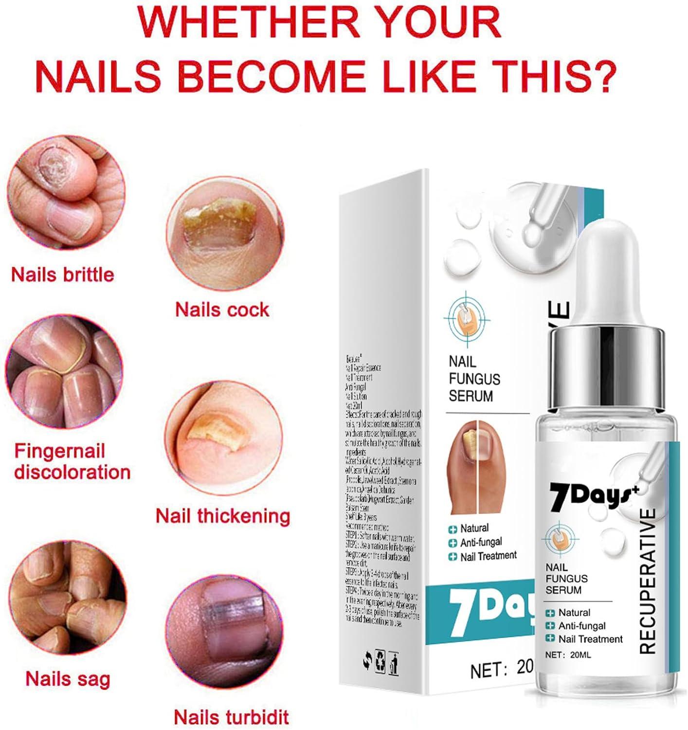 Extra Strong Fungal Nail Treatment for Toenails - Nail Fungus Care ...
