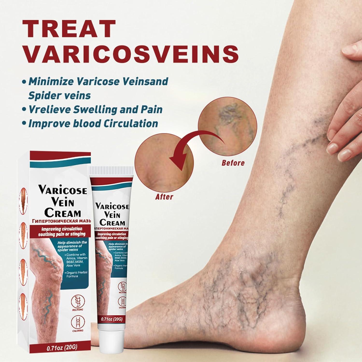 Vein Relief Cream Varicose Vein Cream for Legs Leg Varicose Ointment ...