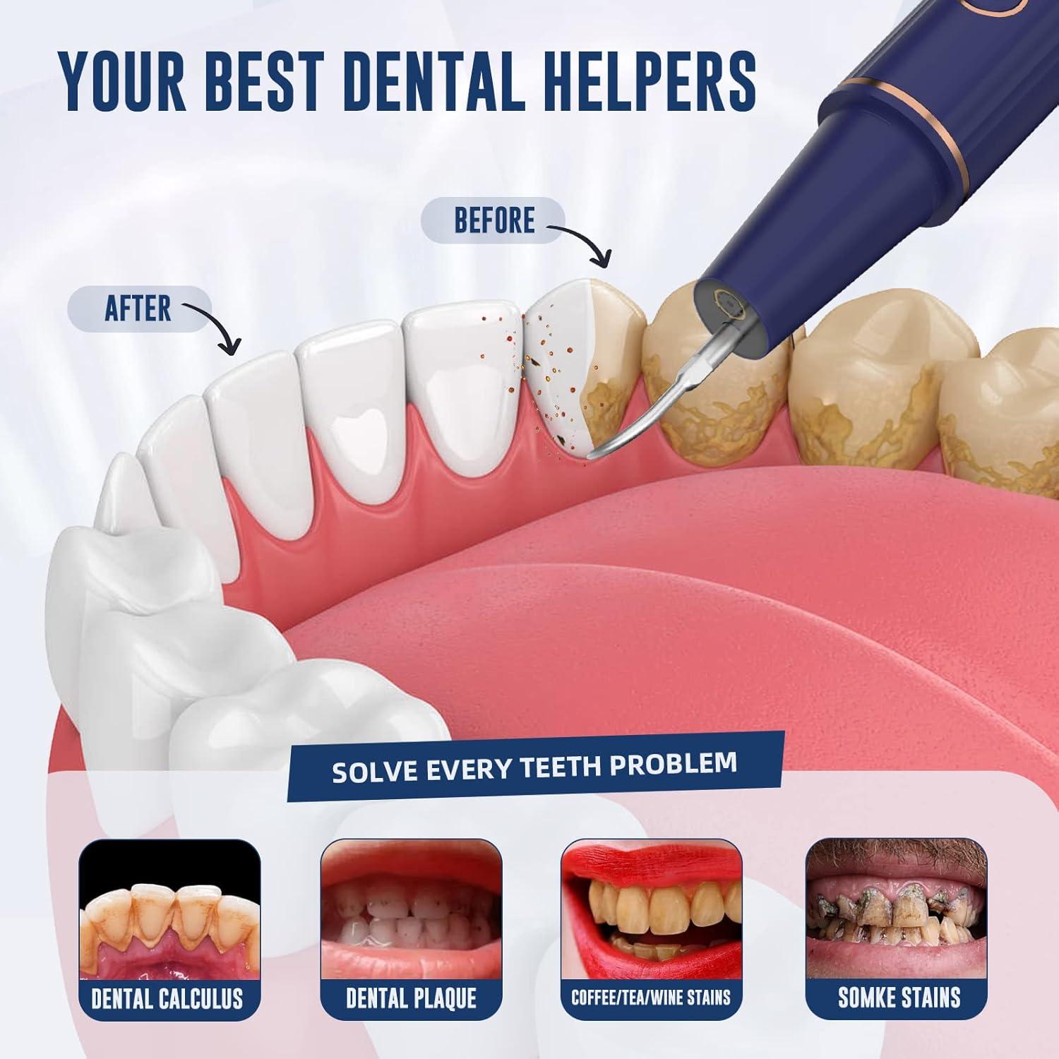 plaque teeth cleaner