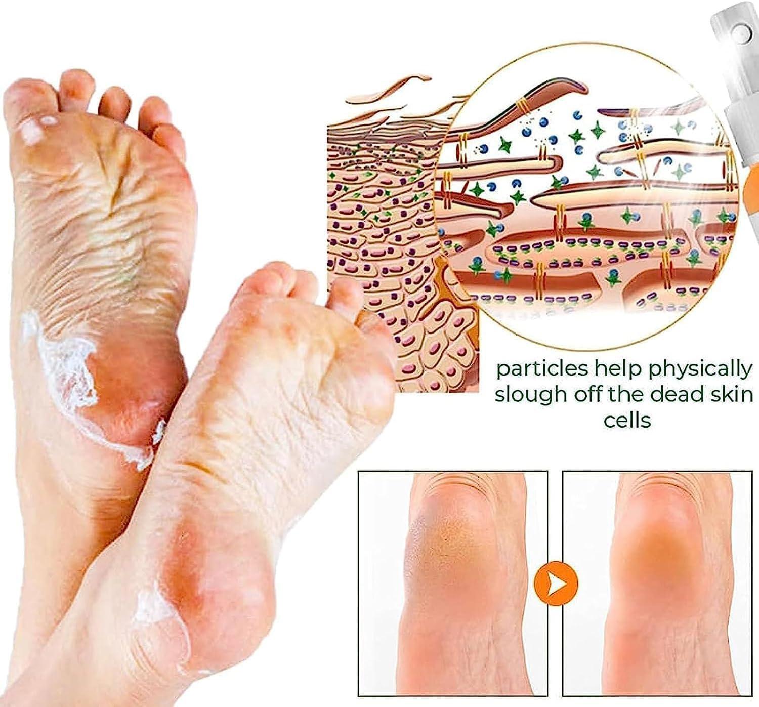 2PC Foot Callus Removal Spray - Instant Dead Skin & Callus Peeling with ...