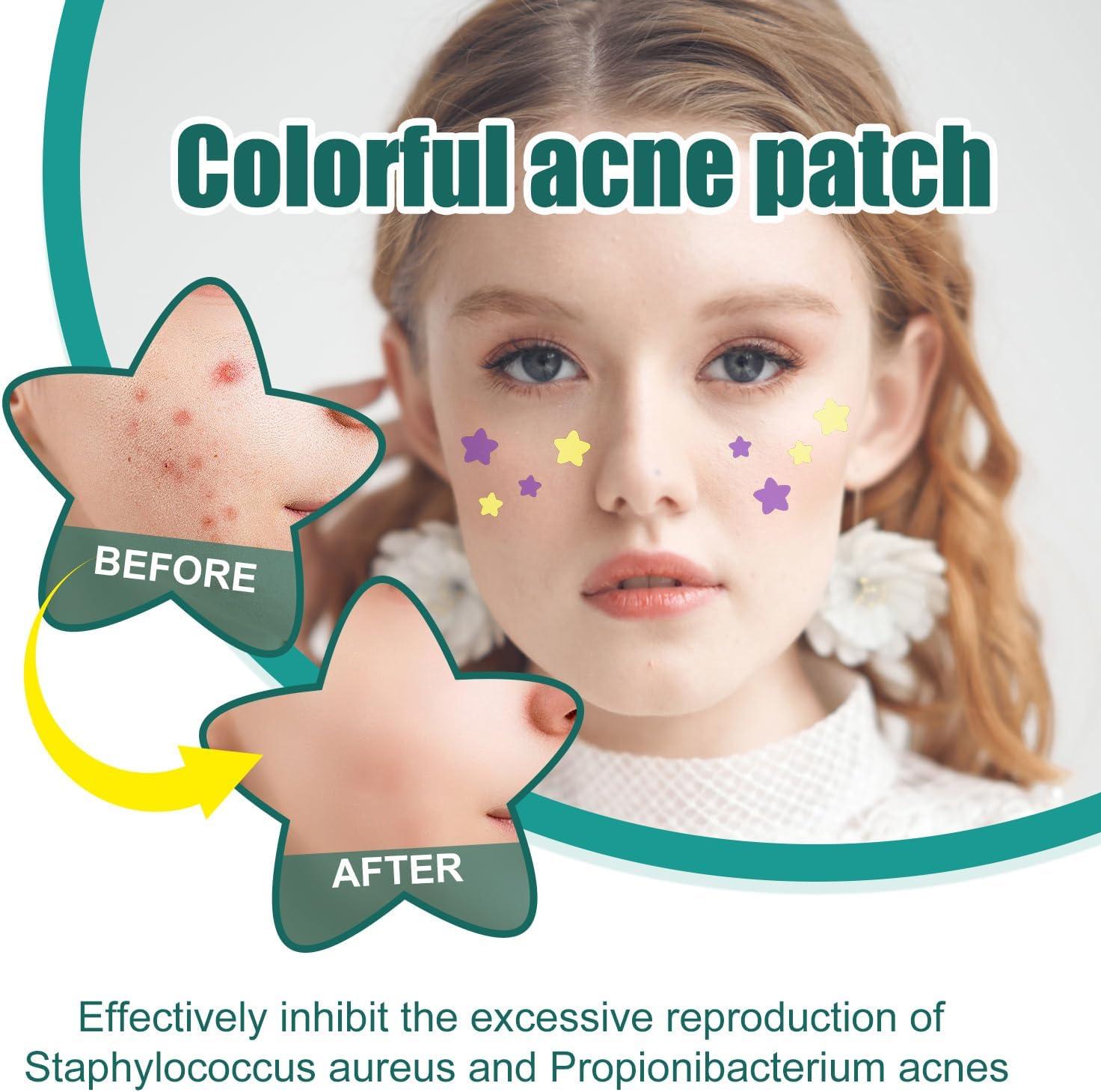 Pimple Patches Hydrocolloid Acne Patch for Face & Body | Calms ...
