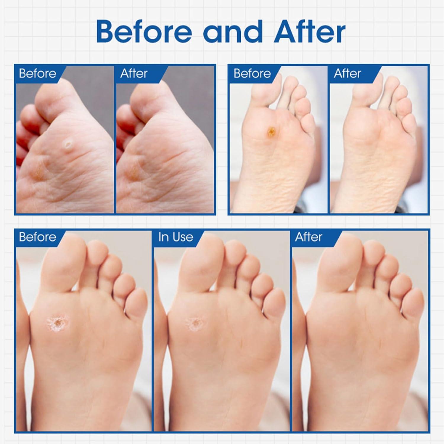 Foot Corn Remover Pads - 24 Pcs Corn Removal Plasters for Feet & Toe ...