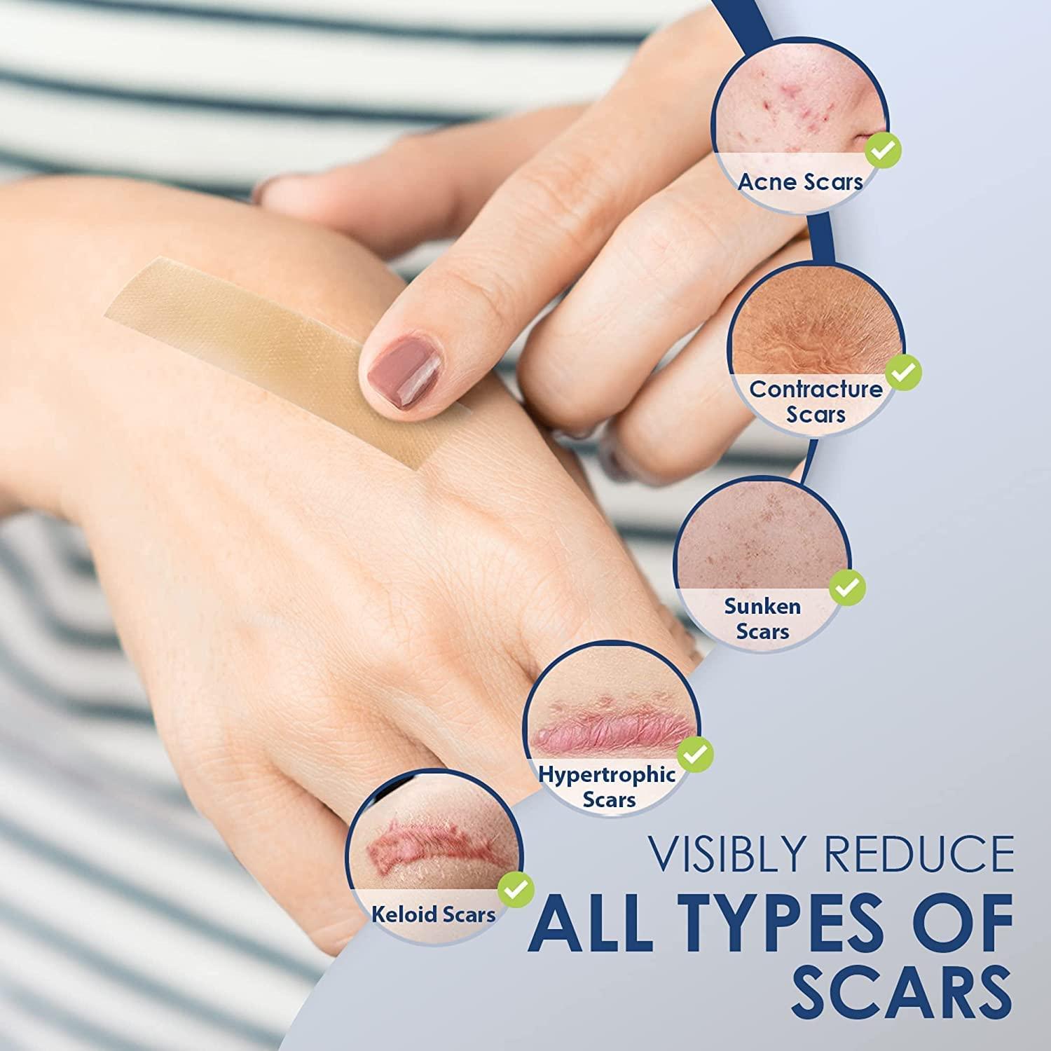 Scar Away Silicone Scar Sheets - Advanced Formula for Fast Scar Removal ...