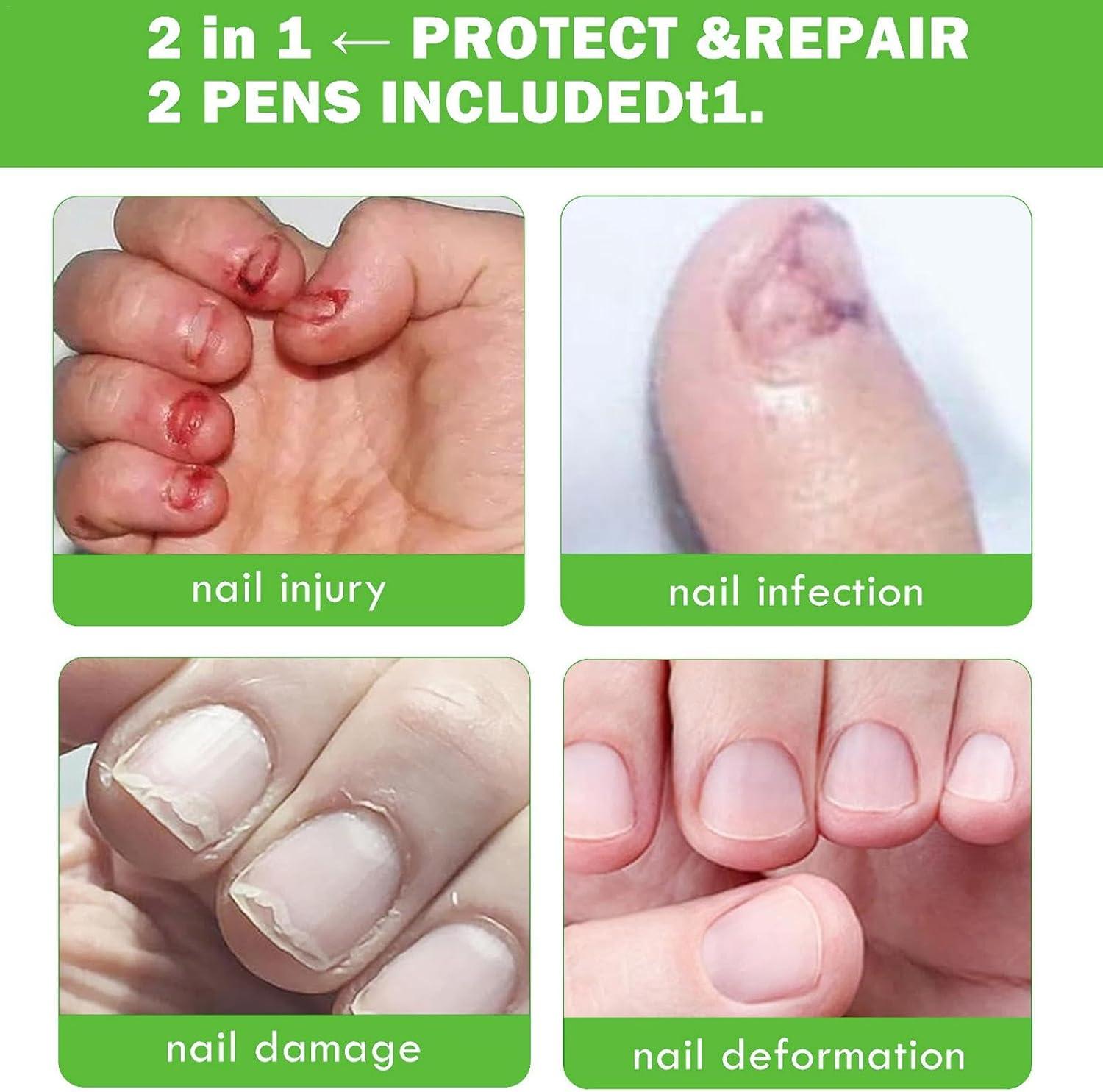 Bexdug Anti Nail Biting - Nail Strengthener Thumb Sucking Solution Nail Care Long-Lasting Finger ...