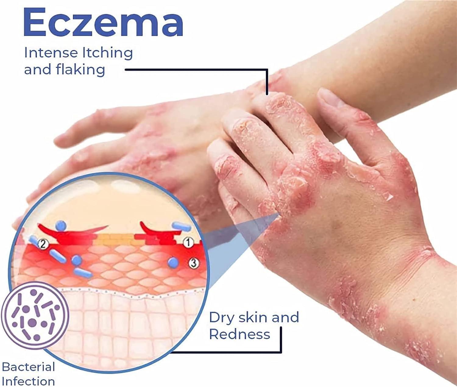 Eczema Therapy Spray Natural Eczema Relief Spray Eczema Treatment Fast Acting Itch Relief (1Pcs)