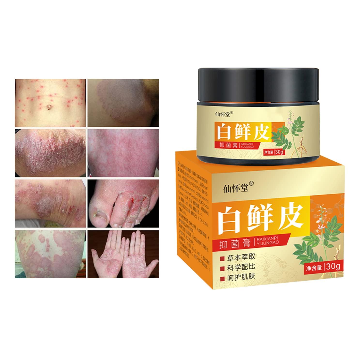 Natural Chinese Herb Eczema Psoriasis Cream for Dry & Itchy Skin Relief ...
