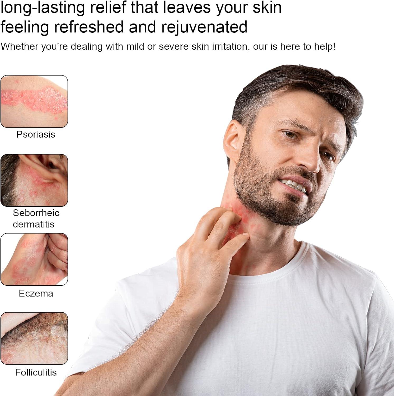 Heat Rash Cream Eczema Hand Foot Treat Tinea Versicolor Itchy Feet Butt ...