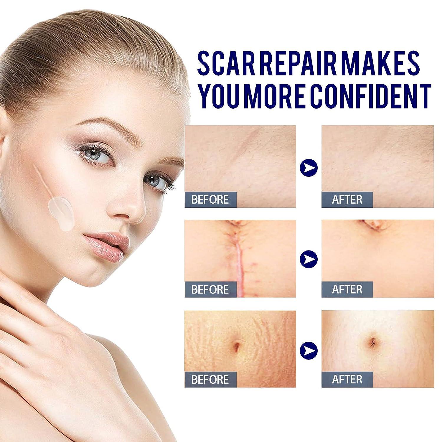 Scar Cream Gel with Retinol, Allantoin & Vitamin E - Advanced Scar ...