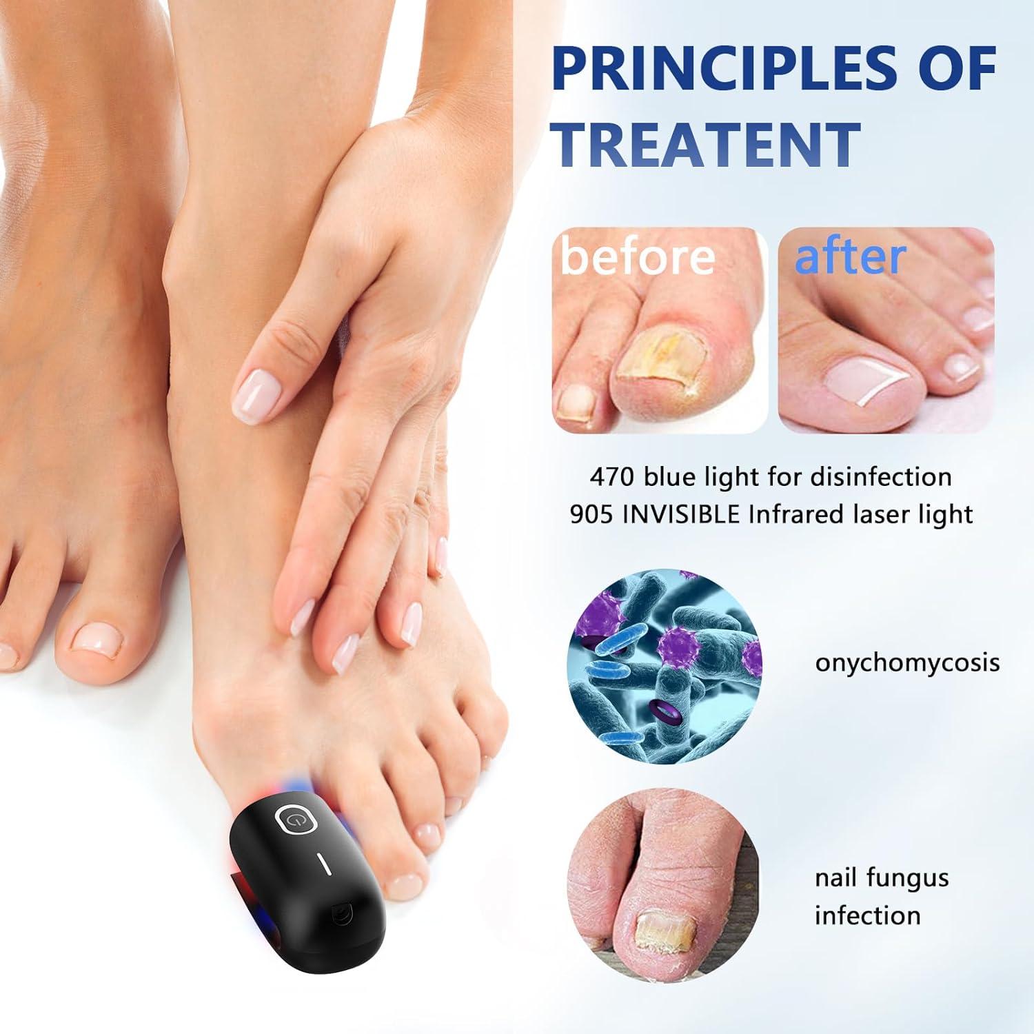 Nail Fungus Laser Treatment Device for Home Use | Effective ...