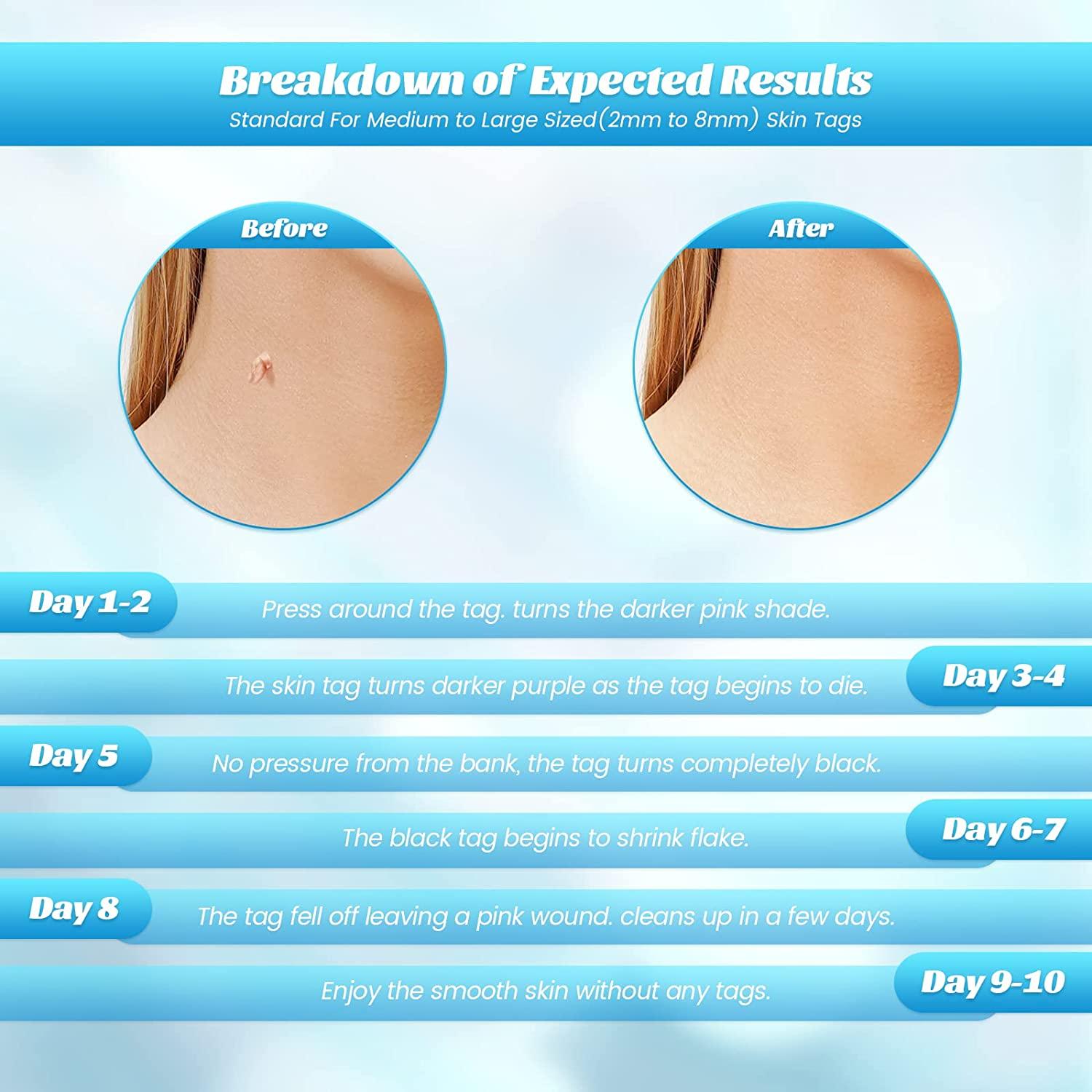 2-in-1 Skin Tag Remover Device for Small to Large Skin Tags | Easy ...