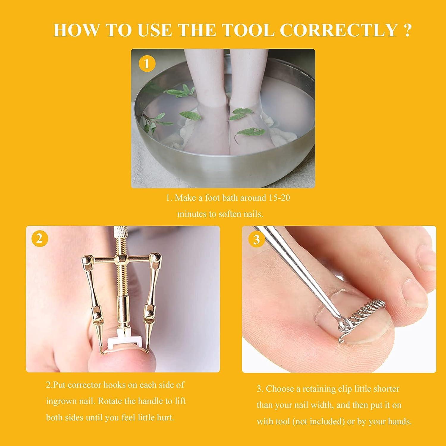 Ingrown Toenail Treatment Kit - Stainless Steel Corrector for Curved ...