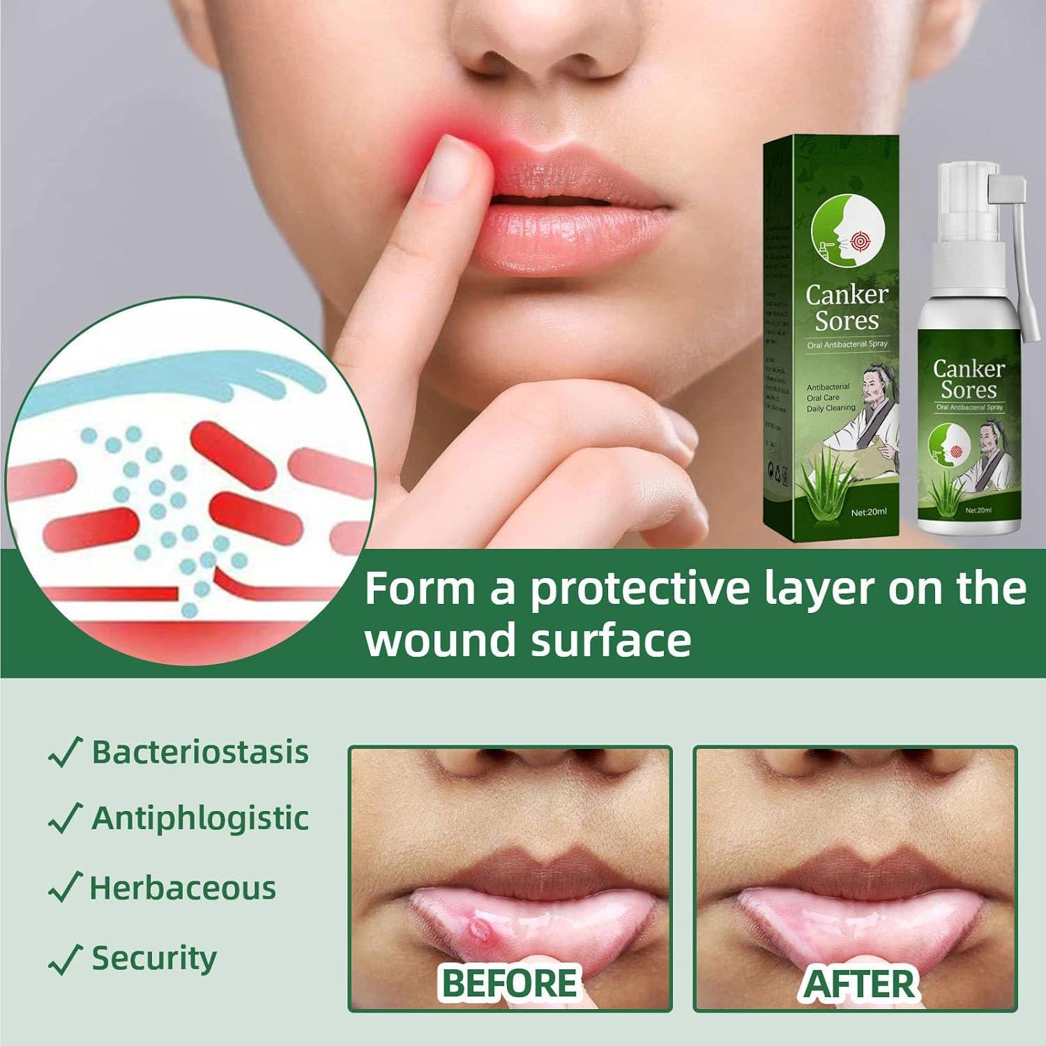 Mouth Bleeding Spray & Ulcer Treatment - Calming Mouth & Throat Spray ...
