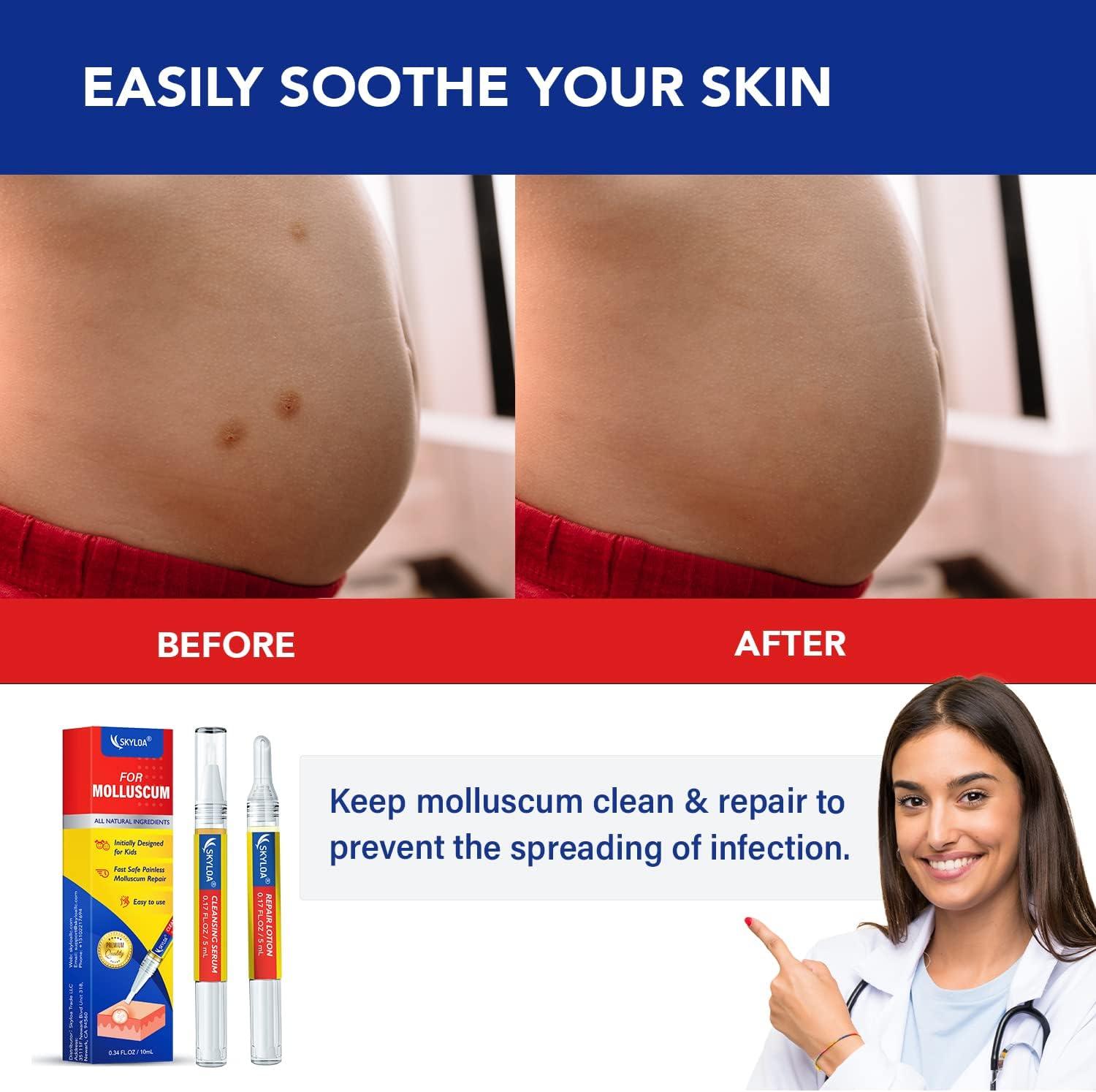 Molluscum Contagiosum Treatment