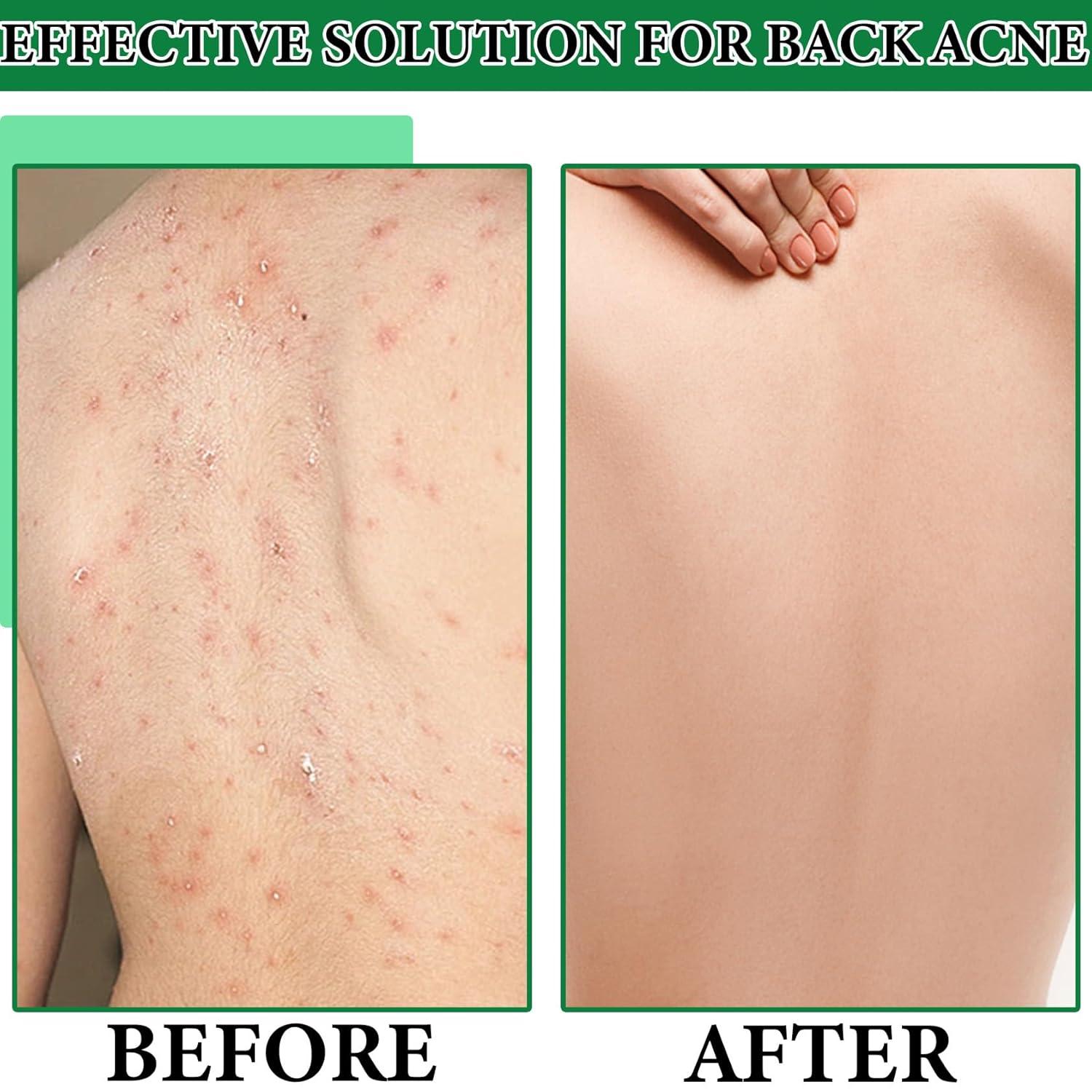 Best Back Acne Treatment Spray - Salicylic Acid & Tea Leaf Oil Formula ...