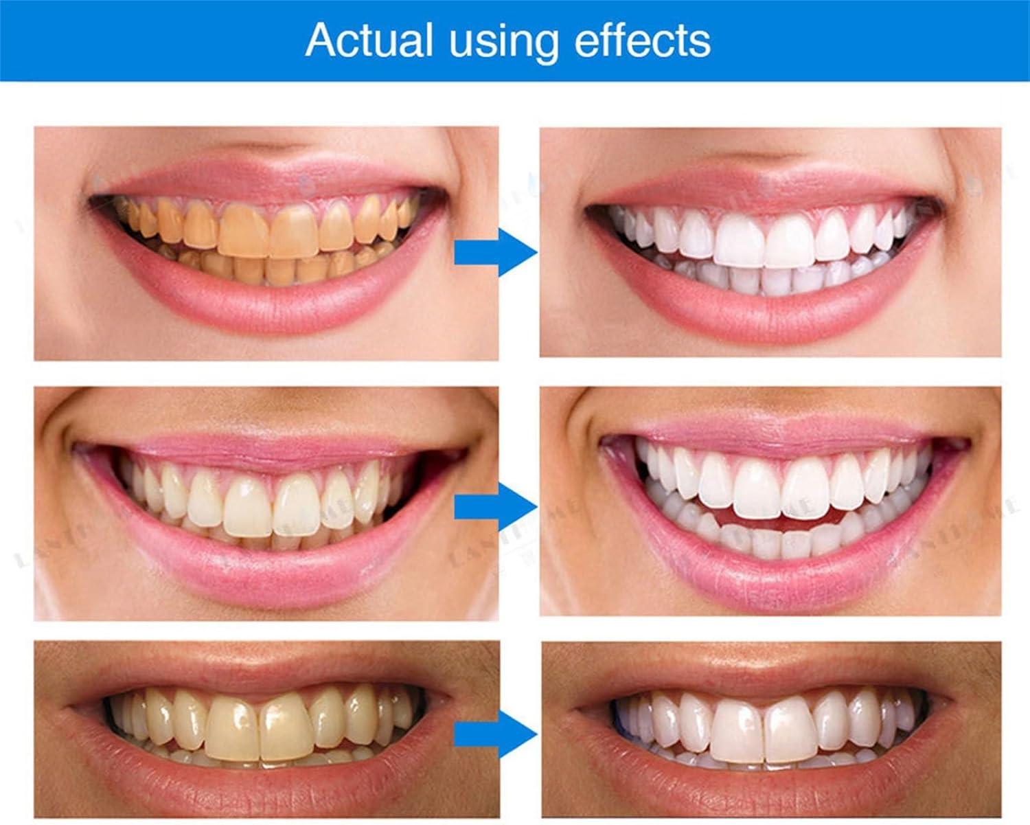 5-Piece Tooth Whitening Pen Kit | Pain-Free Teeth Bleaching | Quick ...