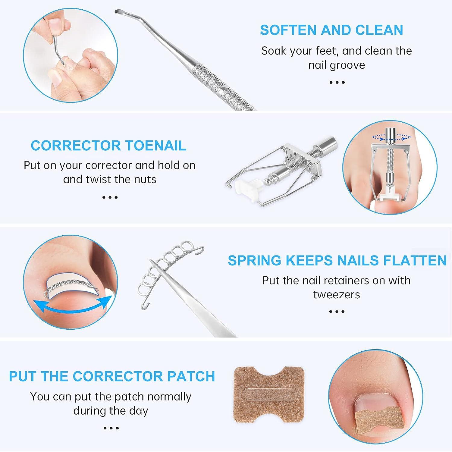 Ingrown Toenail Treatment Kit with 12 Braces, 50 Nail Patches, and ...