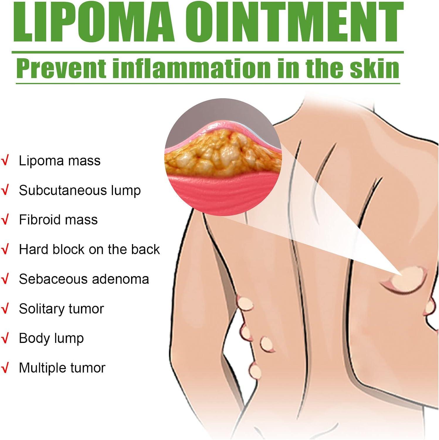 Delipidation Cream for Lipoma Removal and Anti-Swelling - Cellulite Ointment for Lipoma Lumps ...