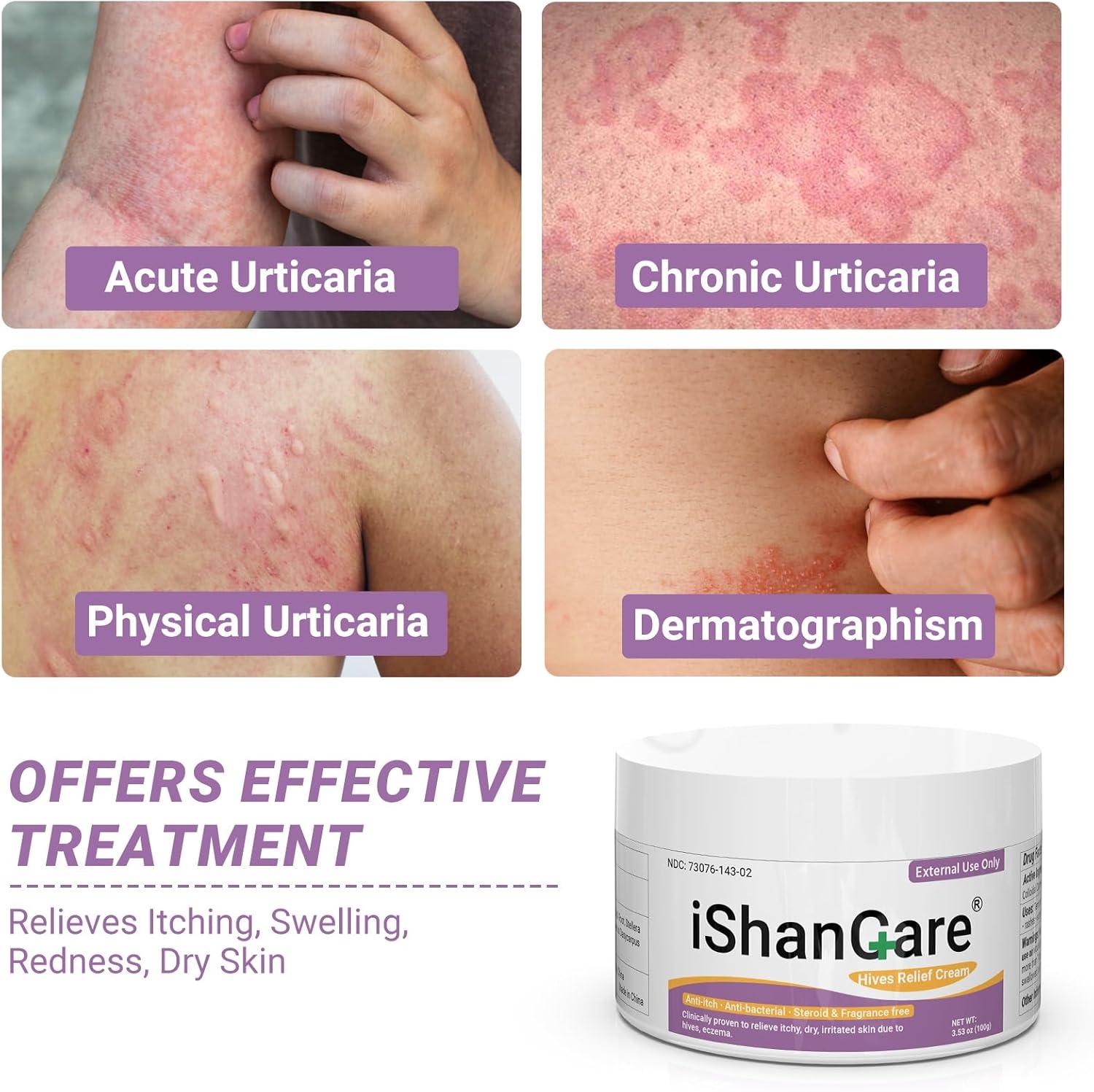 Urticaria Cream - Fast Relief for Hives Allergic Rashes & Itchy Skin ...
