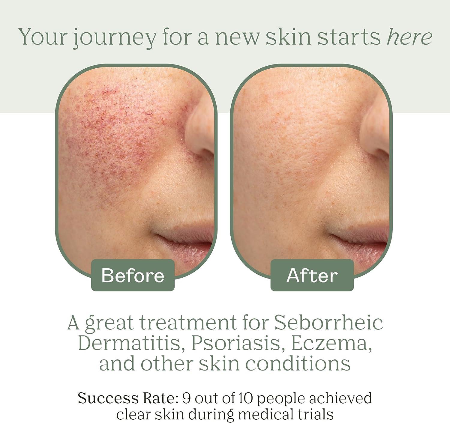 Dermabon Seborrheic Dermatitis Cream with Calendula Extract, Salicylic ...