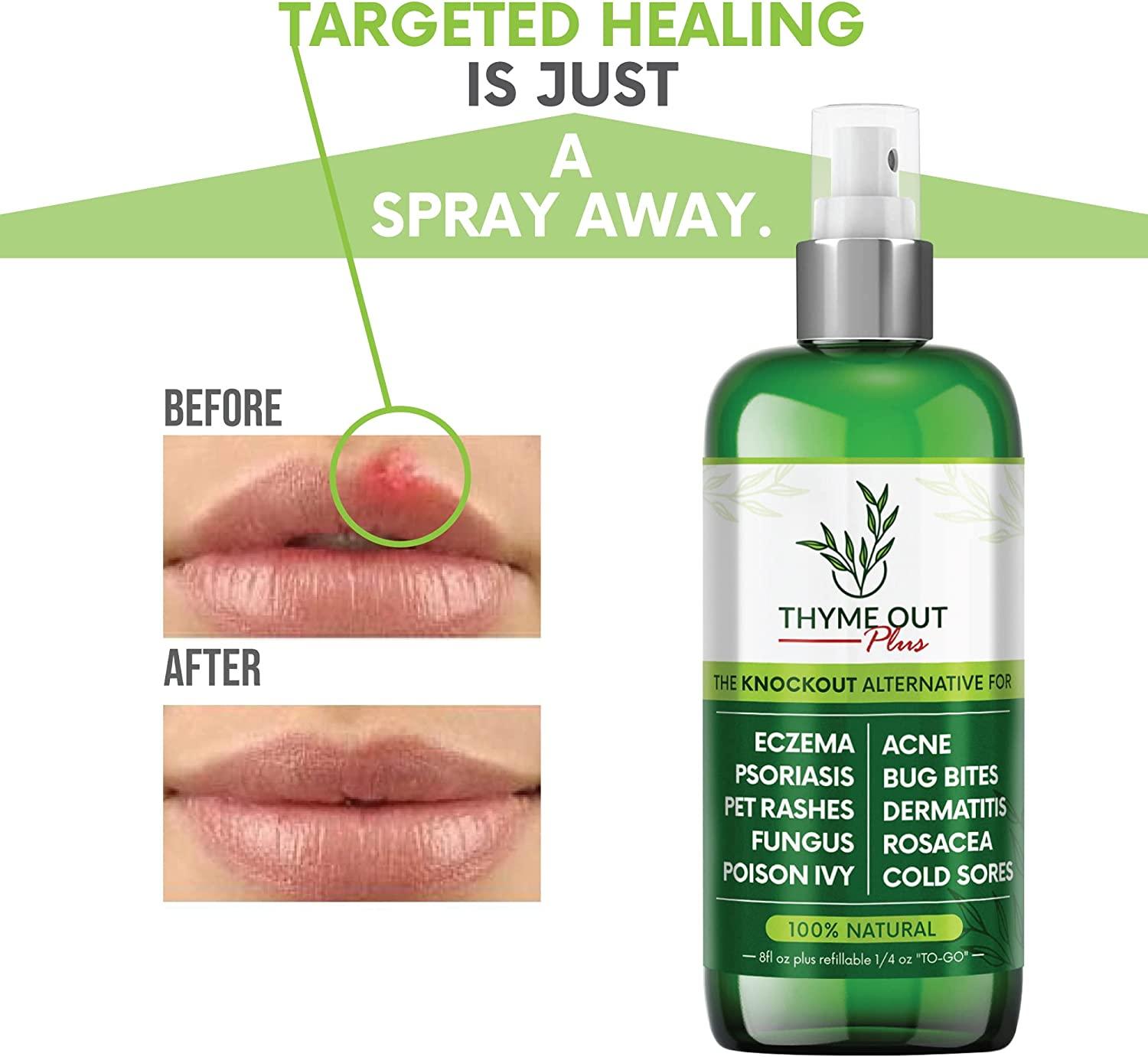 Thyme Out Plus - Eczema, Psoriasis, Acne & Skin Irritation Treatment Spray for Kids & Adults ...