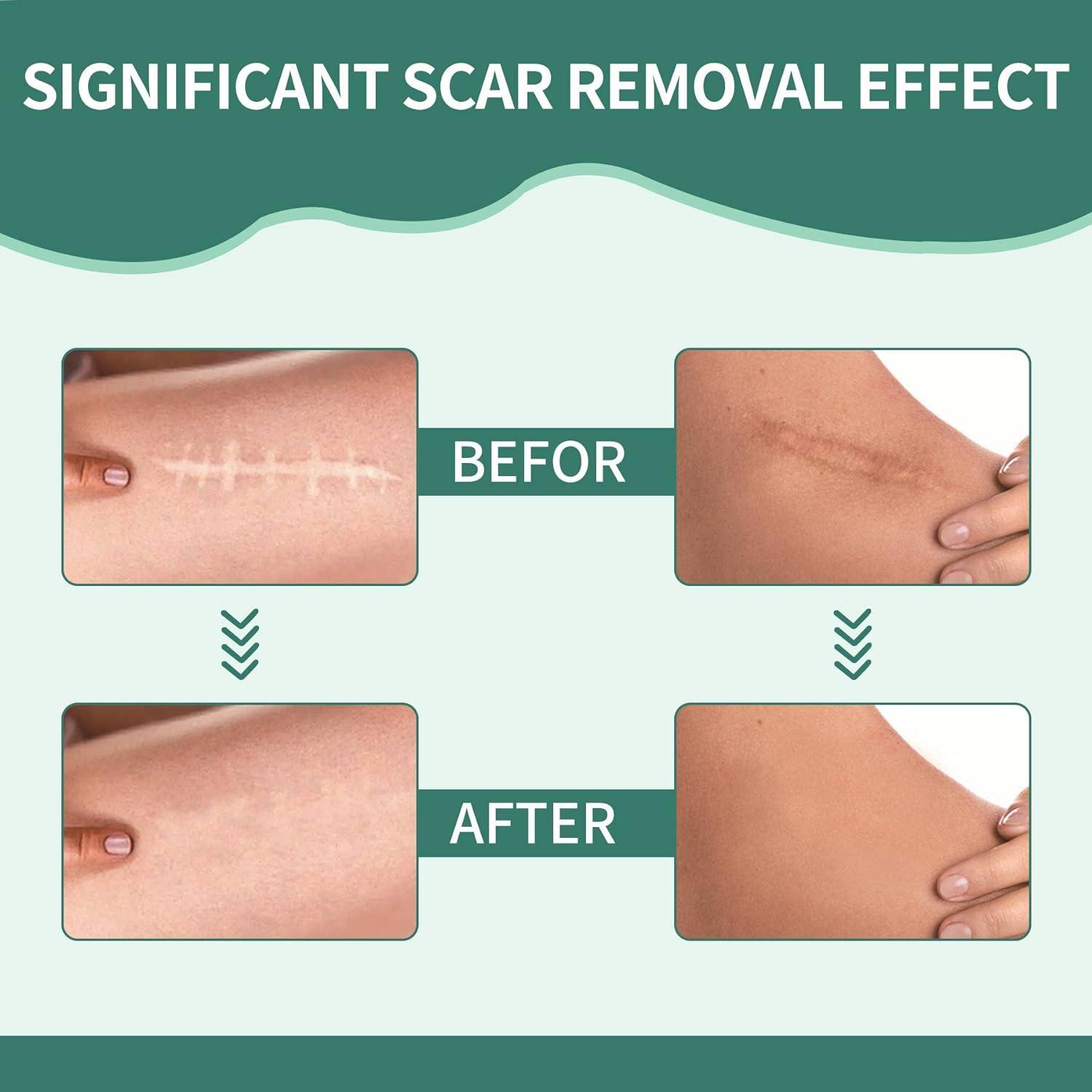 Medical Grade Silicone Scar Sheets (1.57 x 60) - Effective Scar Removal ...