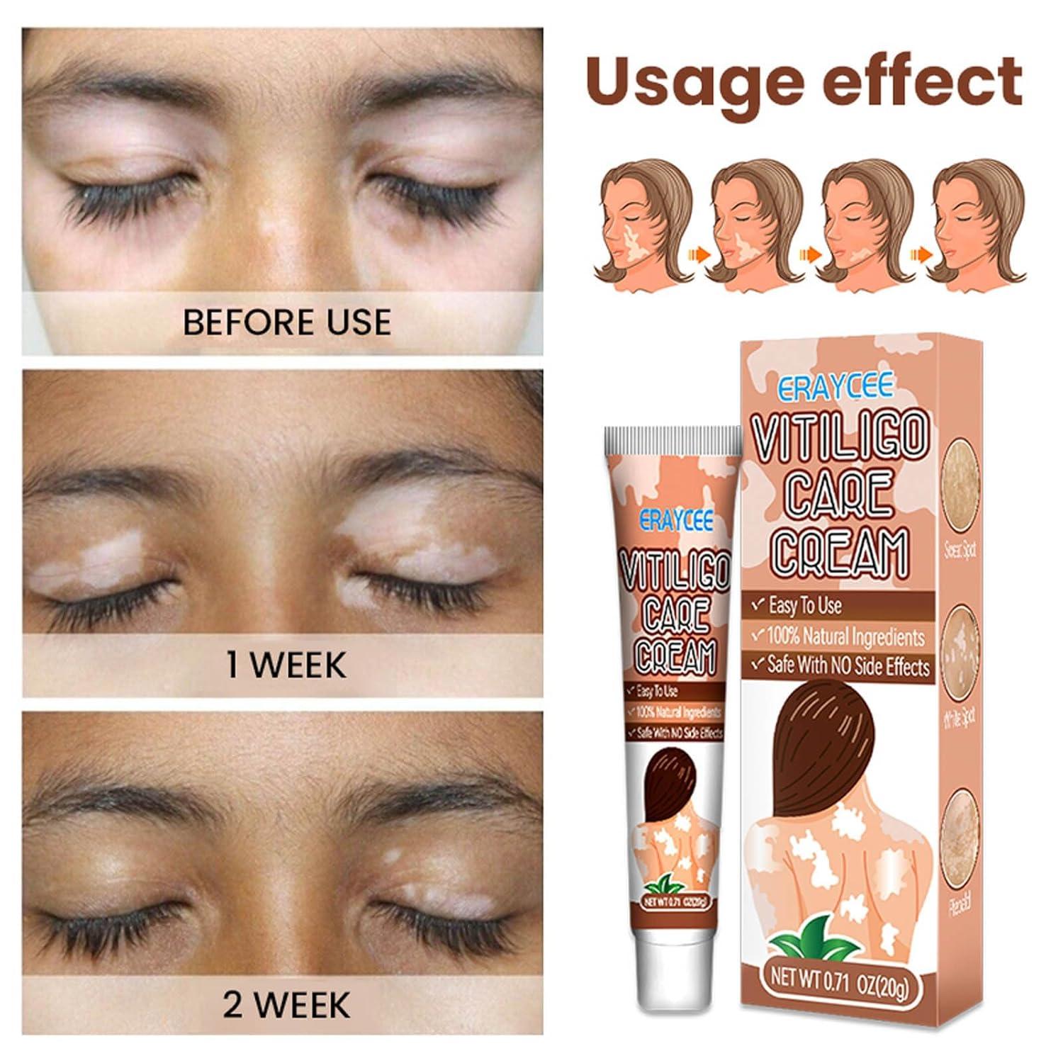 Vitiligo Care Ointment 20g | Repigmentation & Relief Cream | Improves ...