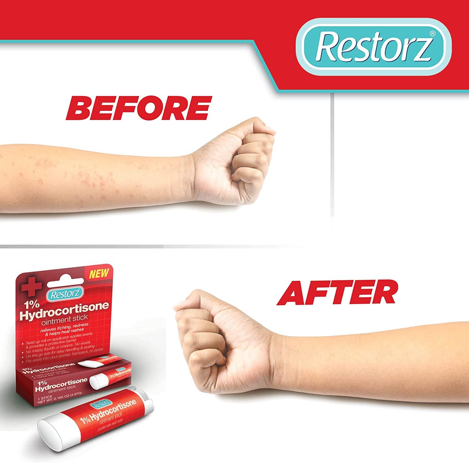 Cortisone For Rashes