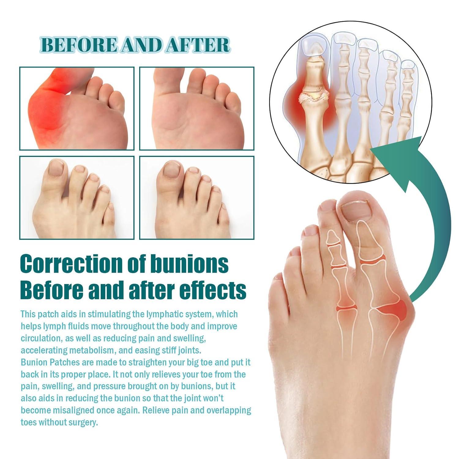 Bunion Relief Fit Patch - Pain Relieving Bunion Corrector Pads (1 Box ...