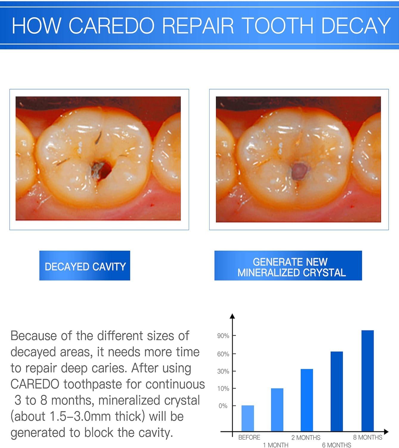 CAREDO Adult Tooth Decay Treatment Toothpaste - Repair Cavities, Dental ...