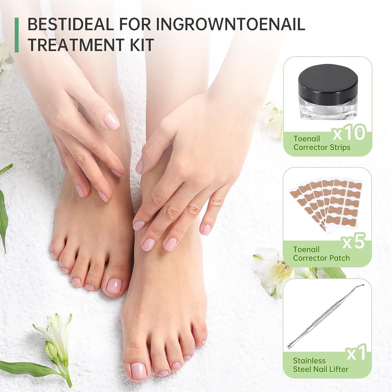 Ingrown Toenail Treatment Kit - 50 Pcs Patches, Corrector Strips, Nail ...