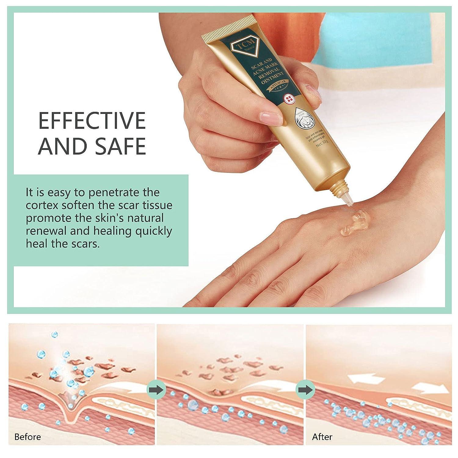 Silicone Scar Ointment 30g - Moisturizing Scar Cream for Smooth ...