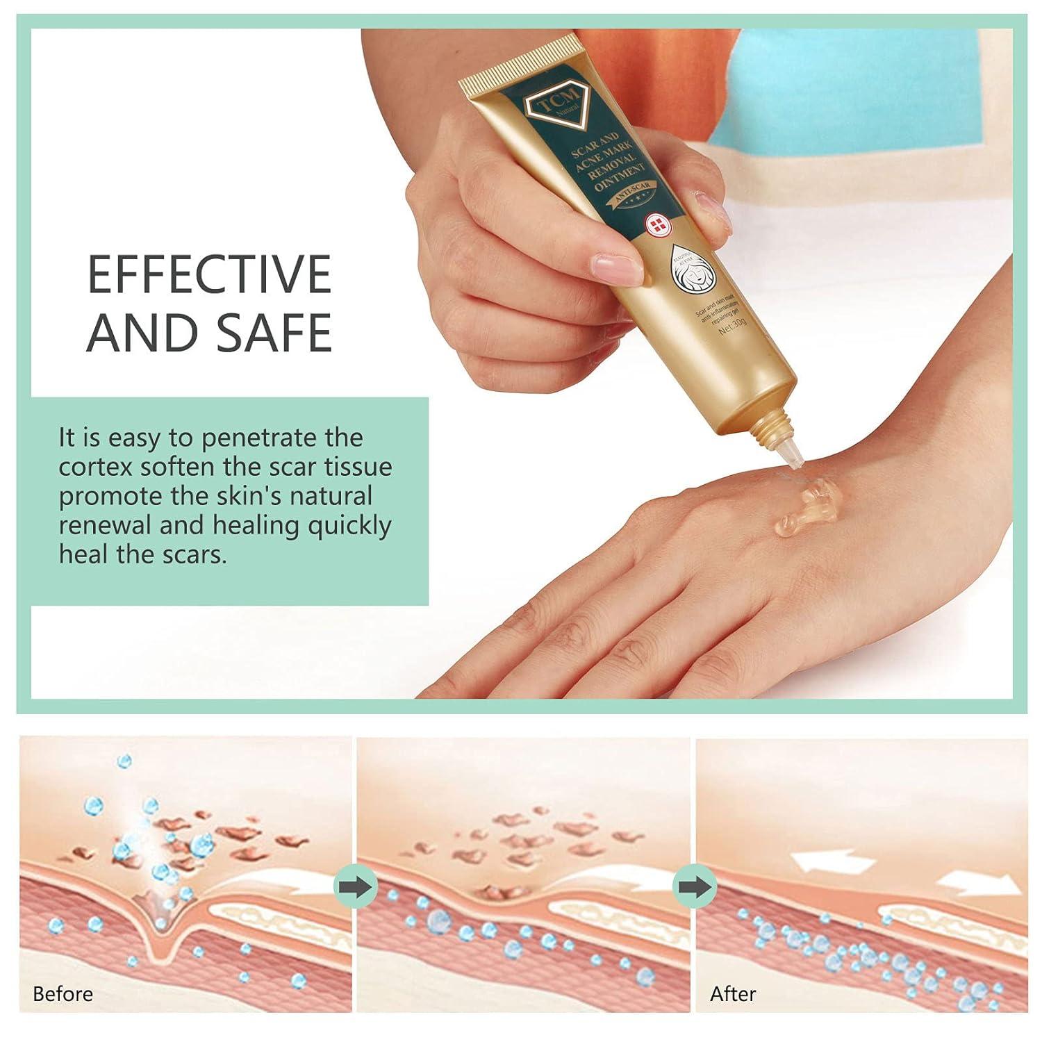 30g Scar Cream - Hydrating Scar Fade Treatment for Surgical Marks ...