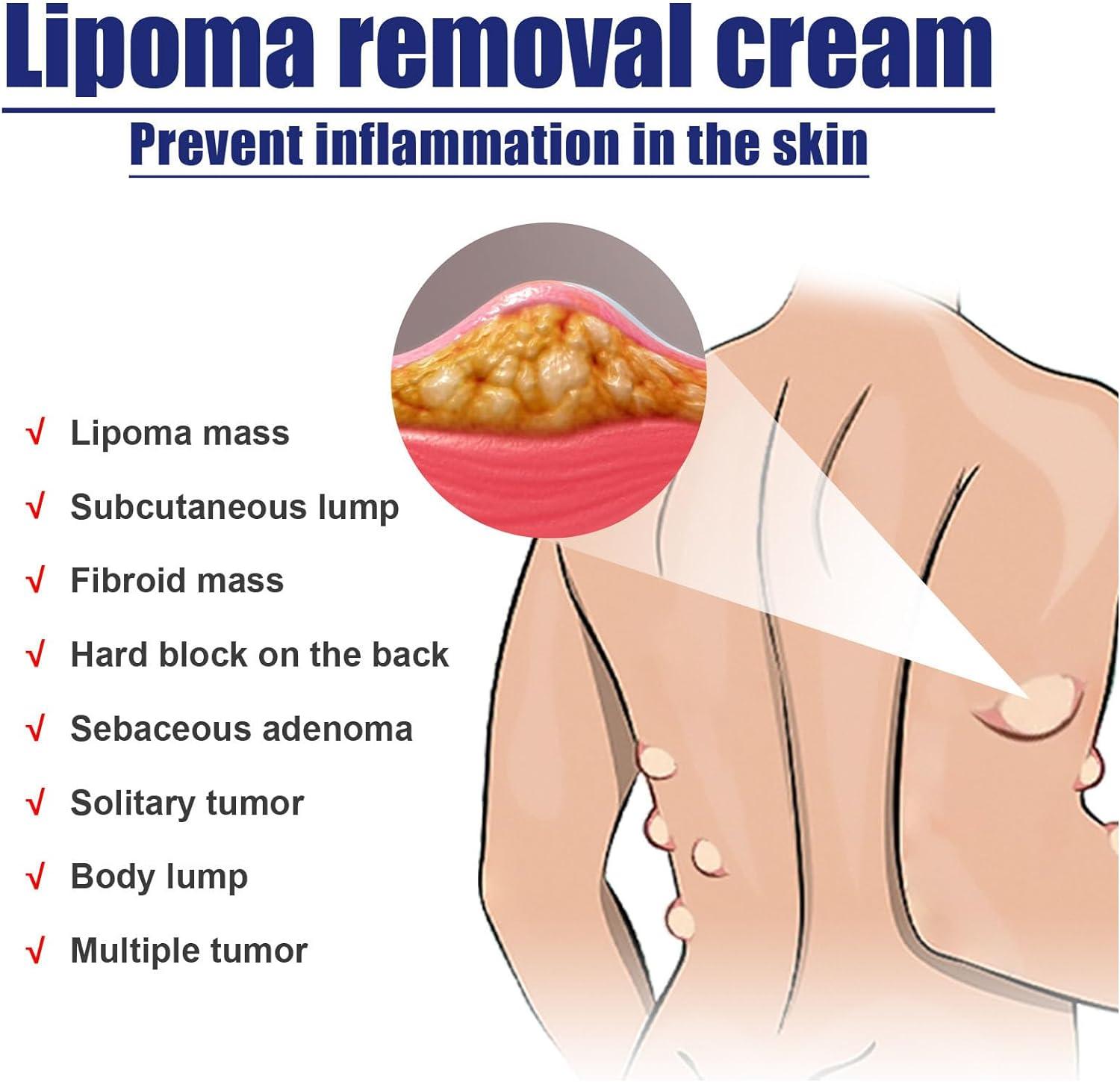 Lipoma Removal Cream 0.7oz | Anti-Inflammatory Cellulite Treatment for ...